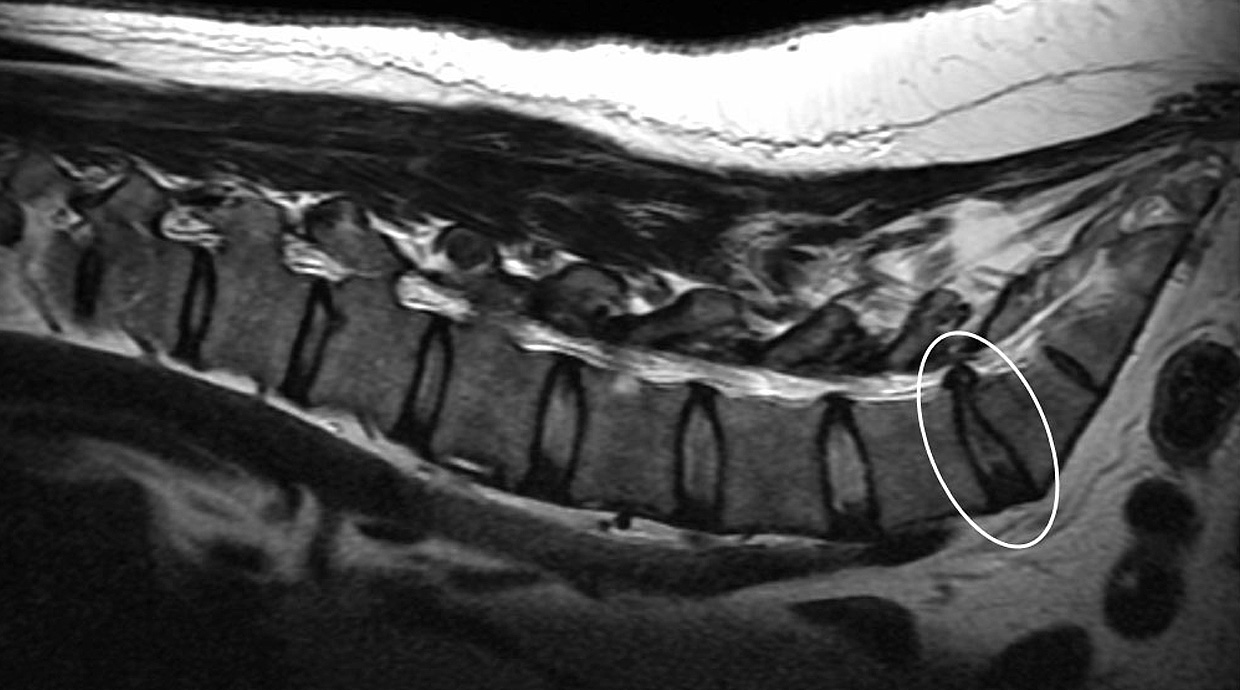 Protruzija diskova: Uzroci, simptomi i metode liječenja
